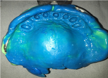 La réhabilitation prothétique du maxillaire par la prothèse composite ...