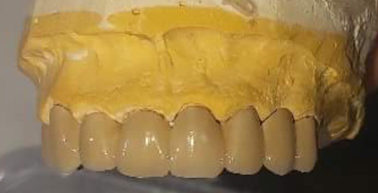 La réhabilitation prothétique du maxillaire par la prothèse composite ...