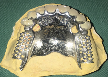 La réhabilitation prothétique du maxillaire par la prothèse composite ...