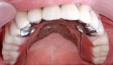 La réhabilitation prothétique du maxillaire par la prothèse composite ...