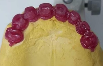 La réhabilitation prothétique du maxillaire par la prothèse composite ...