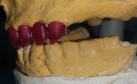 La réhabilitation prothétique du maxillaire par la prothèse composite ...