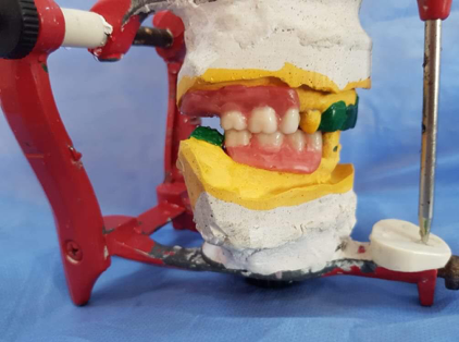 La réhabilitation prothétique du maxillaire par la prothèse composite ...