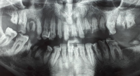 La réhabilitation prothétique du maxillaire par la prothèse composite ...